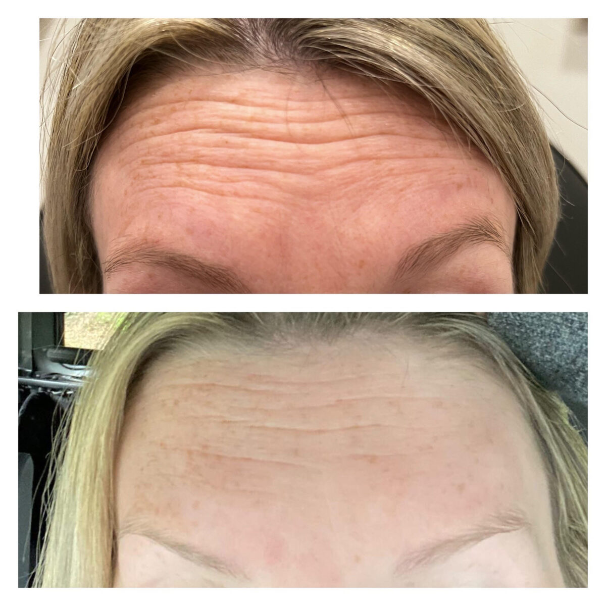 Before & After | Aponi Aesthetics
