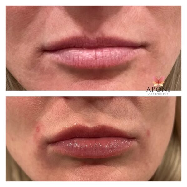 Before & After | Aponi Aesthetics