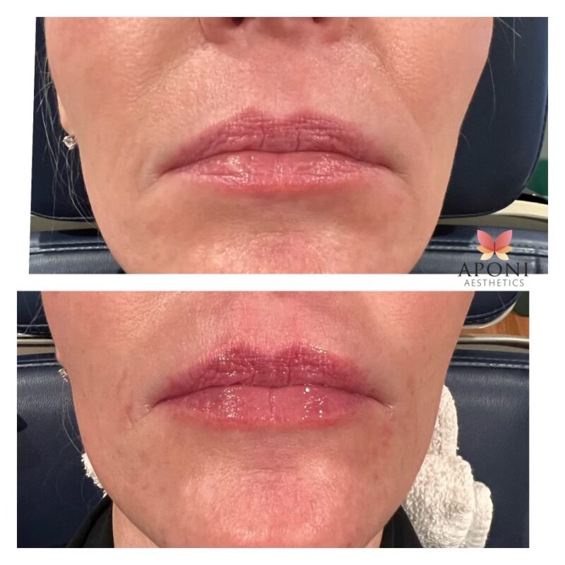 Before & After | Aponi Aesthetics